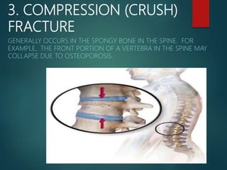 Fracture | PPT
