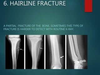 Fracture | PPT