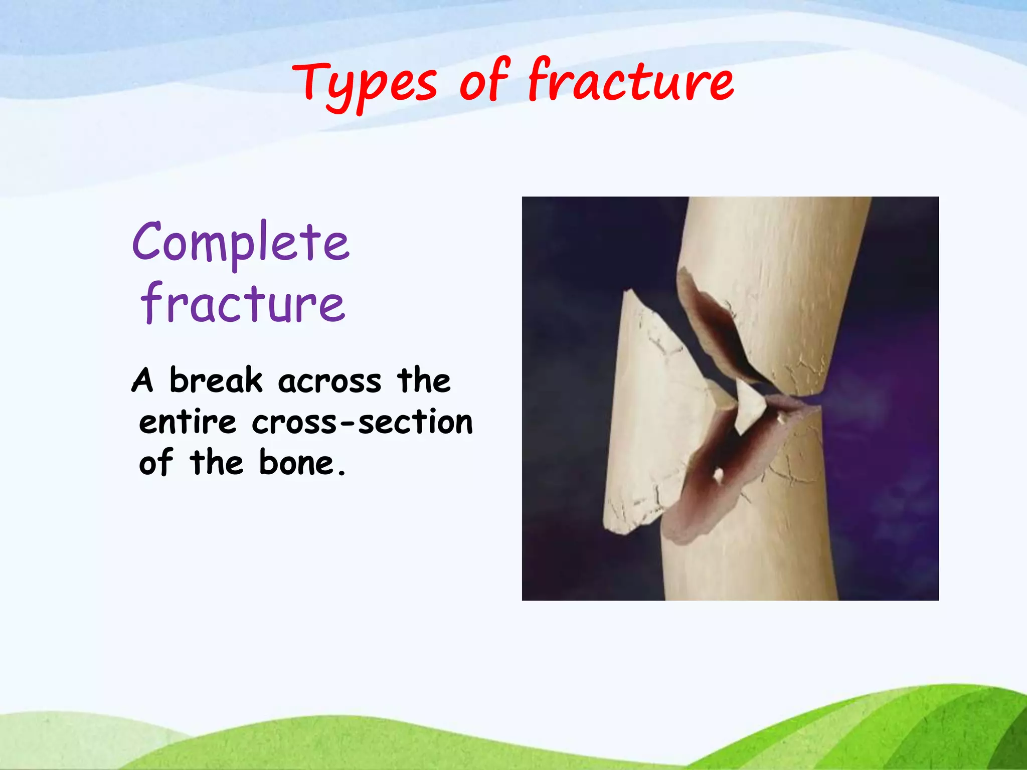 FRACTURE (TYPES AND PATTERN) | PPTX