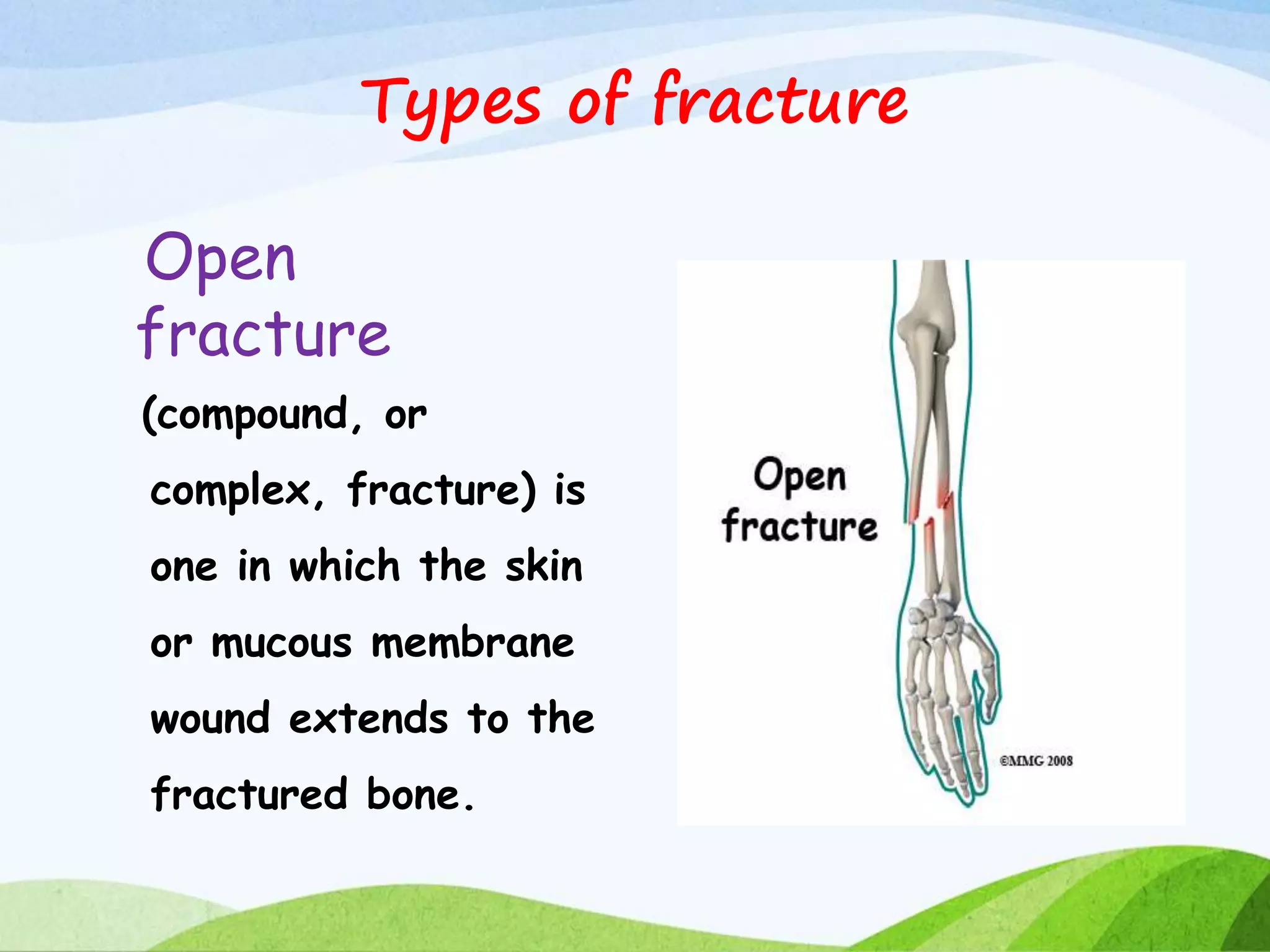 FRACTURE (TYPES AND PATTERN) | PPTX