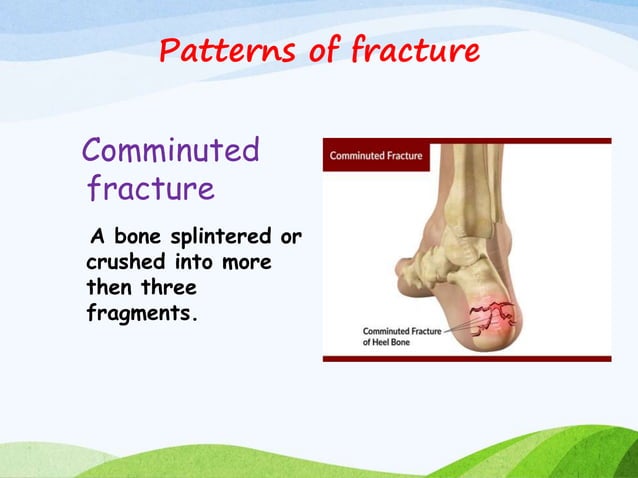 FRACTURE (TYPES AND PATTERN) | PPTX