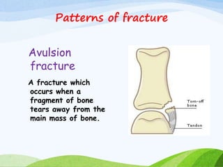 FRACTURE (TYPES AND PATTERN) | PPTX