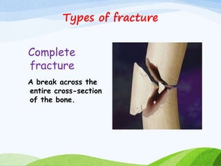 FRACTURE (TYPES AND PATTERN) | PPTX