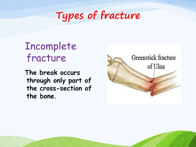FRACTURE (TYPES AND PATTERN) | PPTX