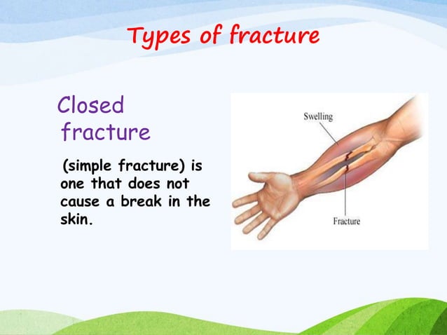 FRACTURE (TYPES AND PATTERN) | PPTX