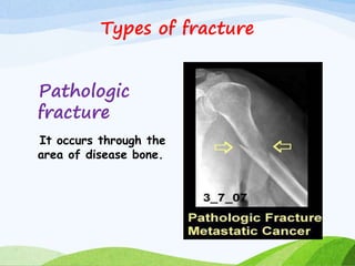 FRACTURE (TYPES AND PATTERN) | PPTX