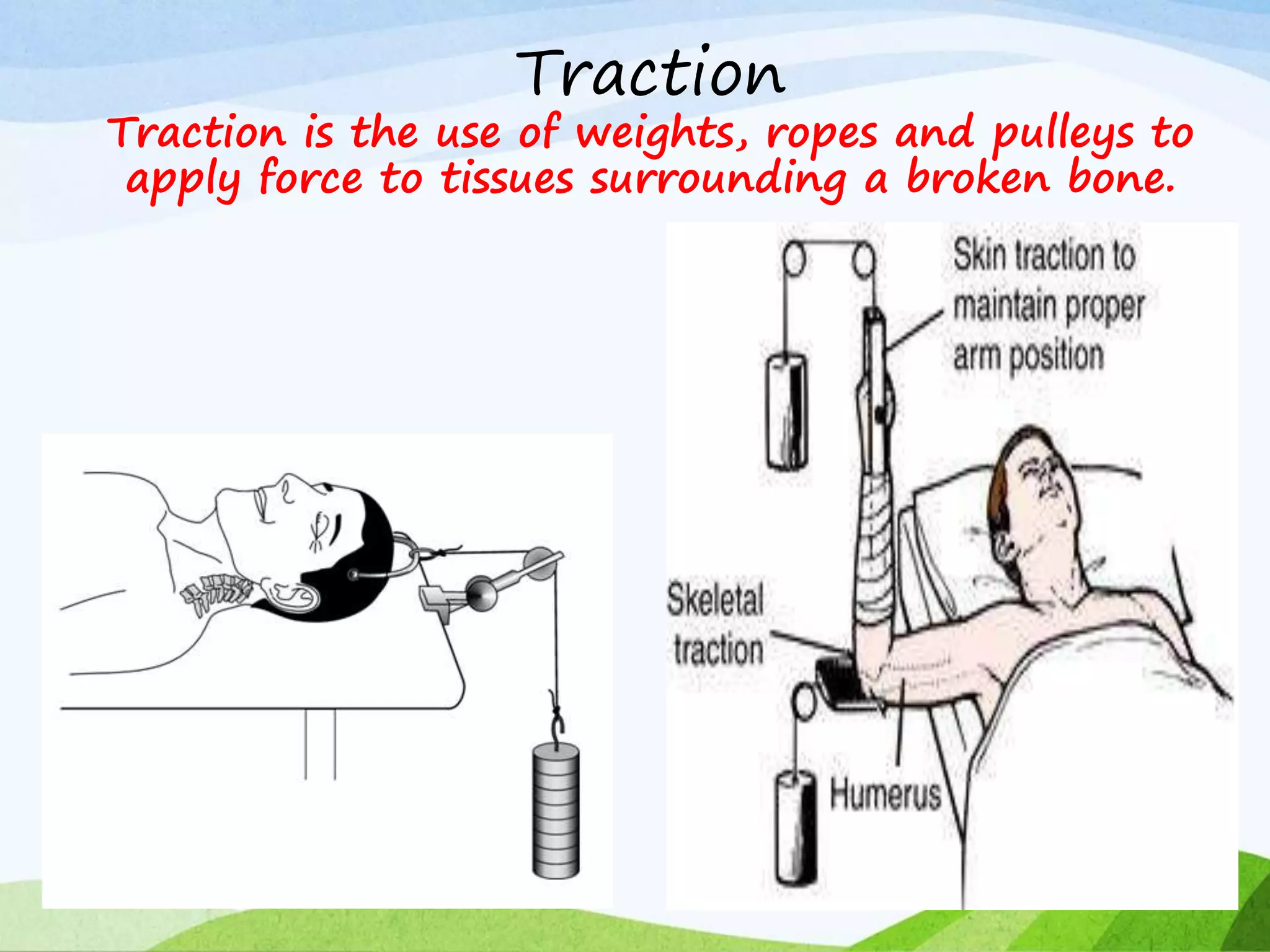 Fracture | PPTX