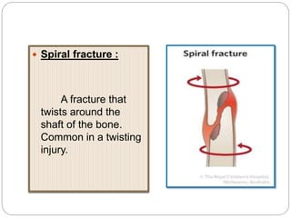 Fracture | PPTX