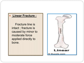Fracture | PPTX