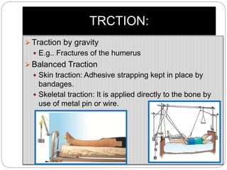 Fracture | PPTX