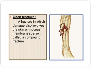 Fracture | PPTX