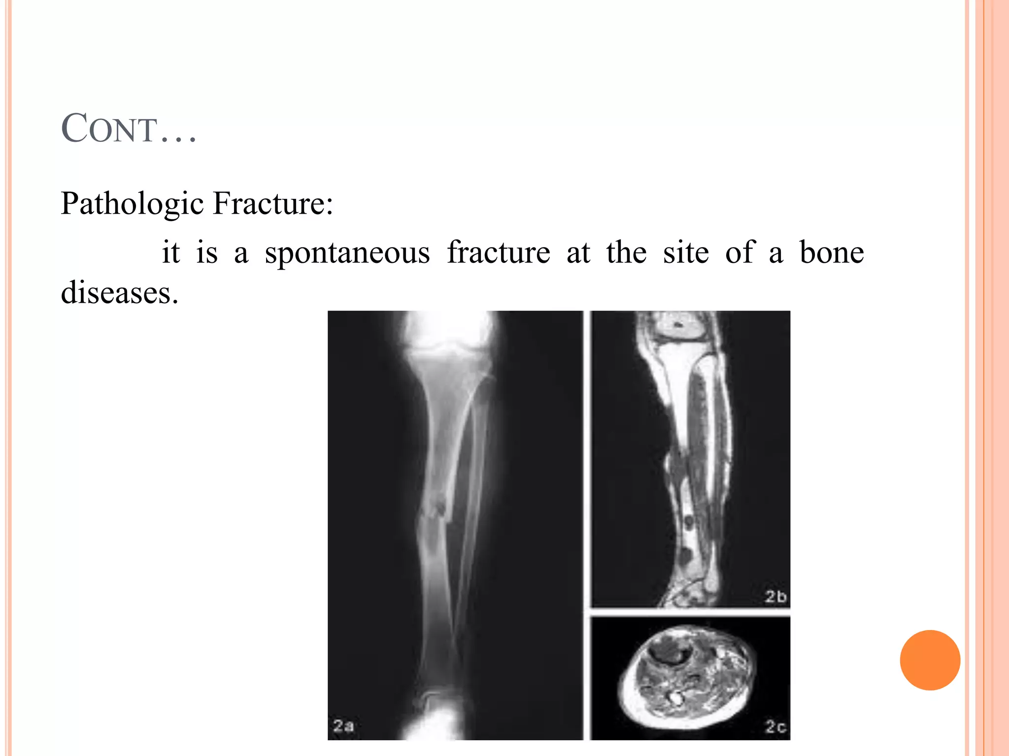 Fracture | PDF