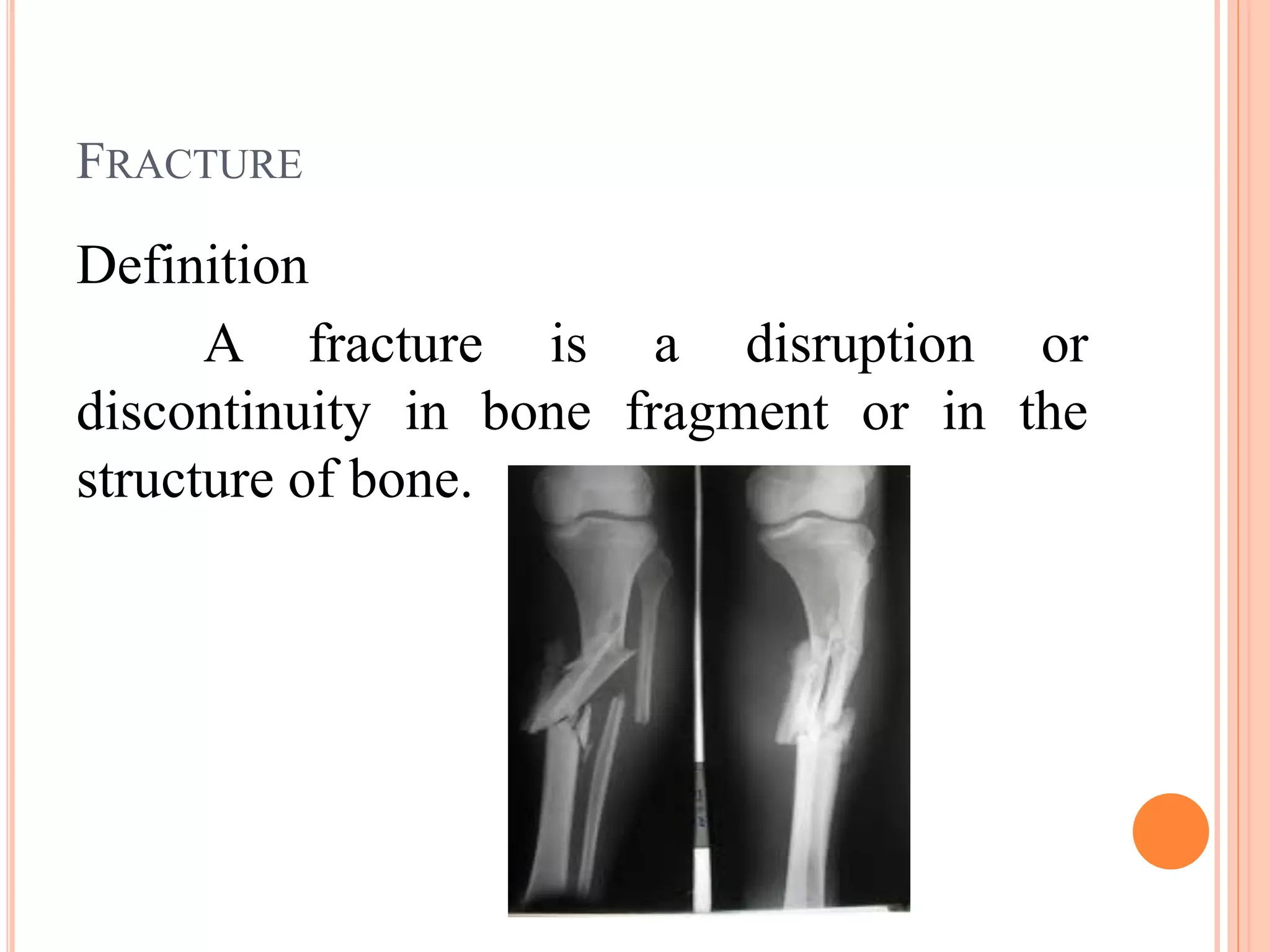 Fracture | PDF