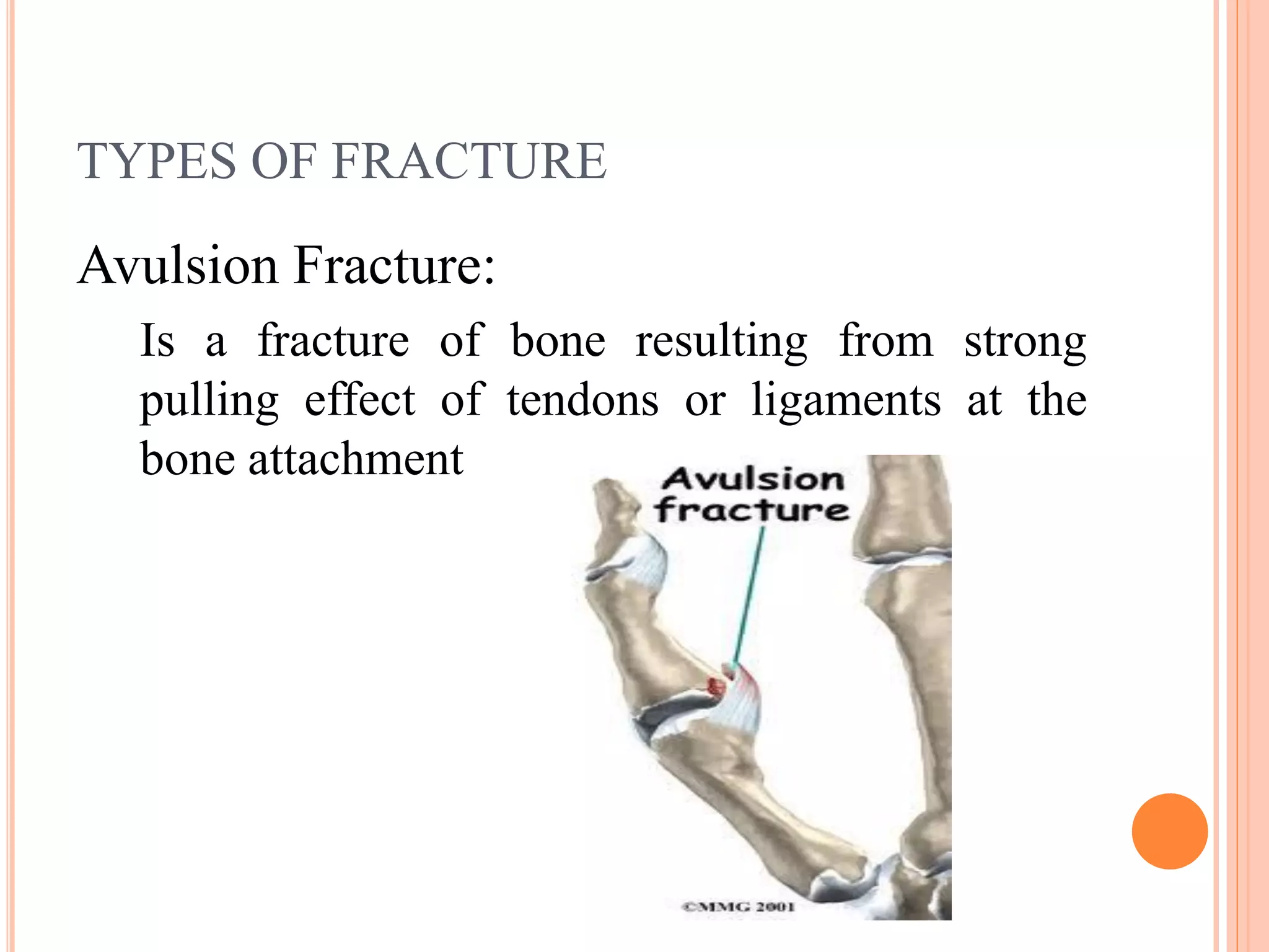 Fracture | PDF