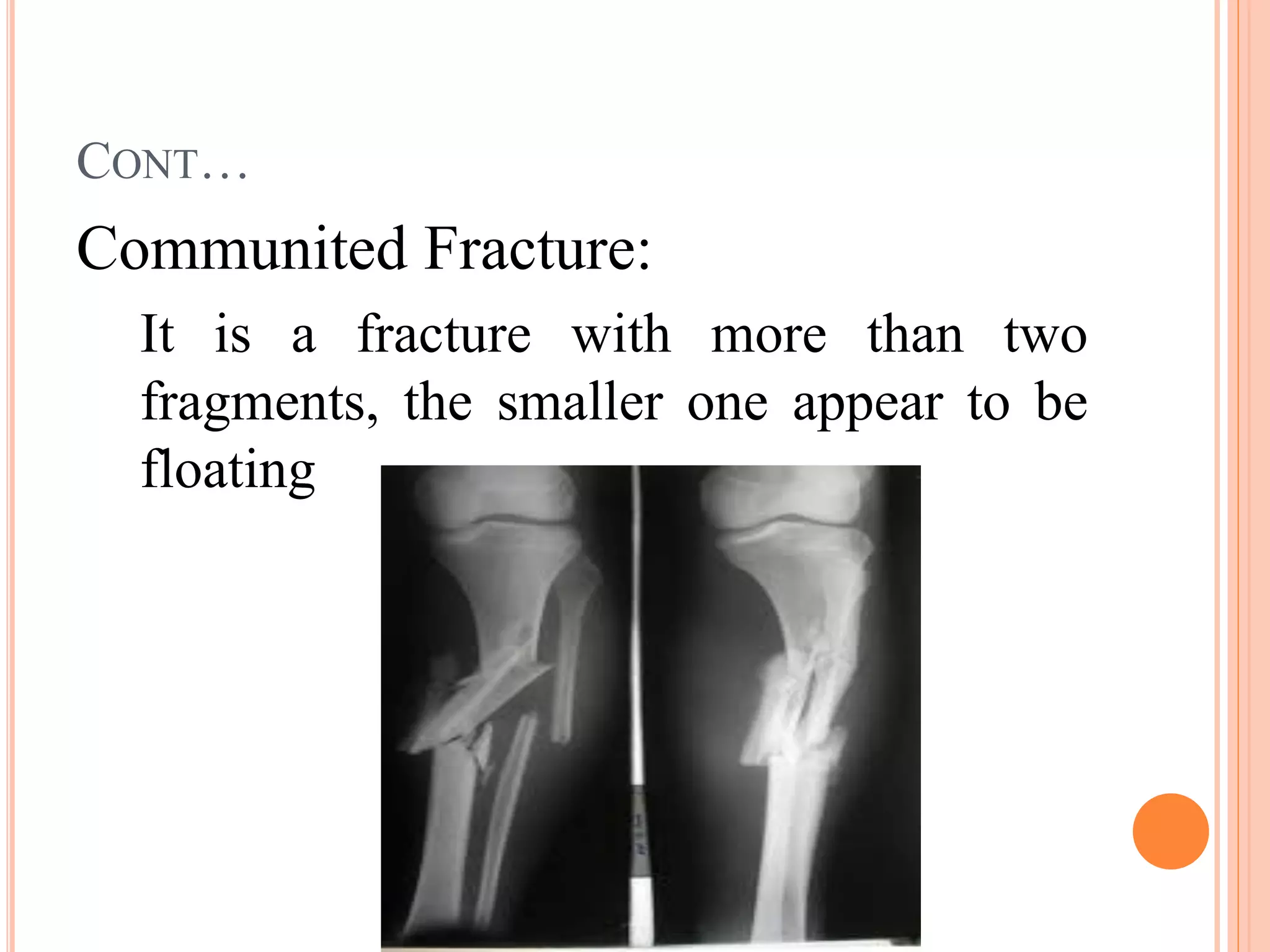 Fracture | PDF