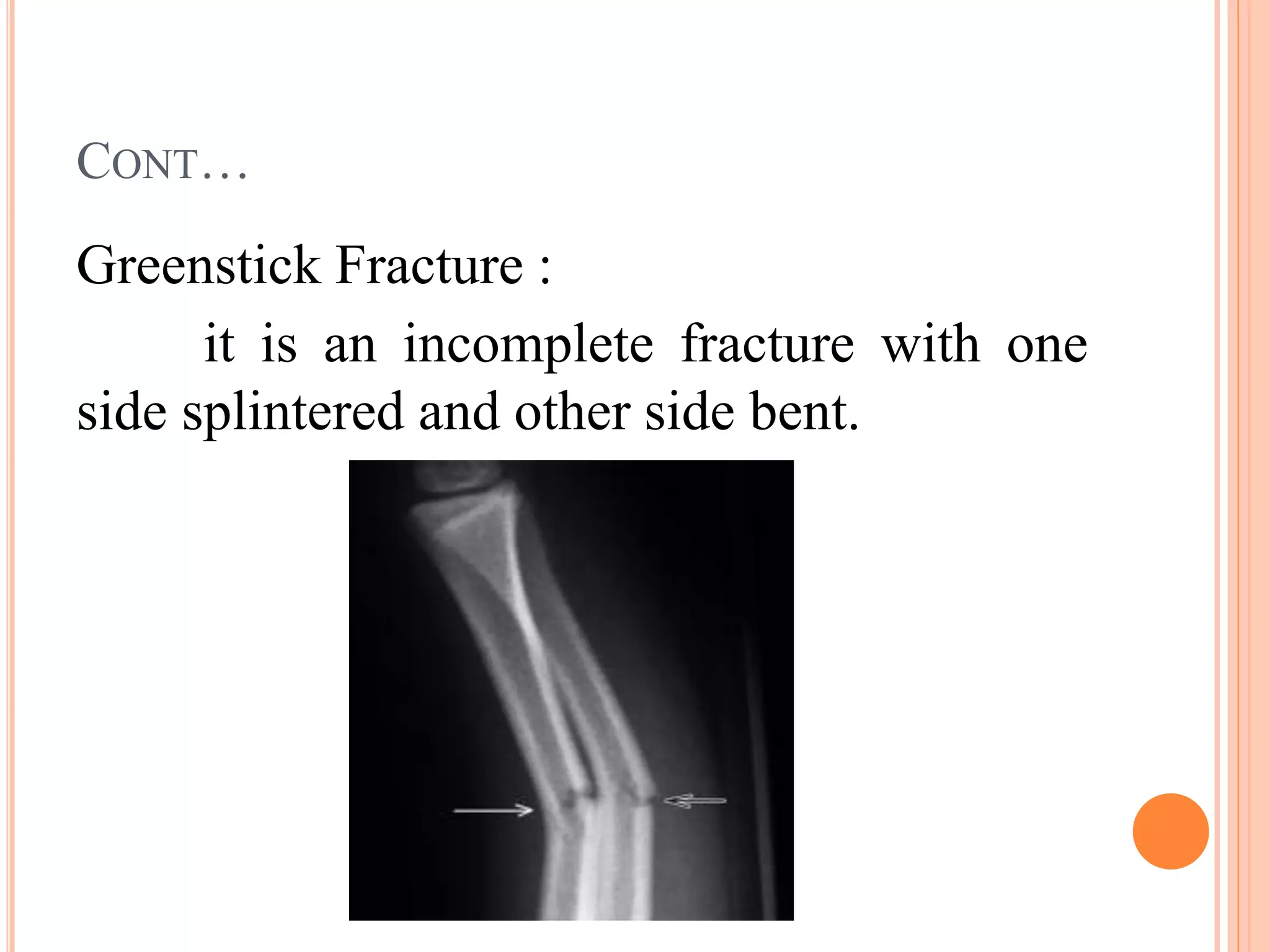 Fracture | PDF