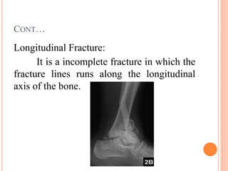 Fracture | PDF