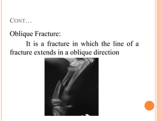 Fracture | PDF