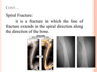 Fracture | PDF