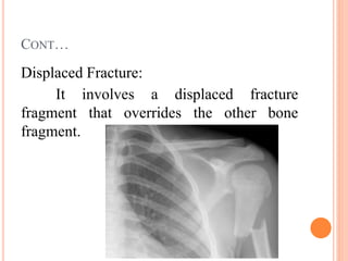 Fracture | PDF