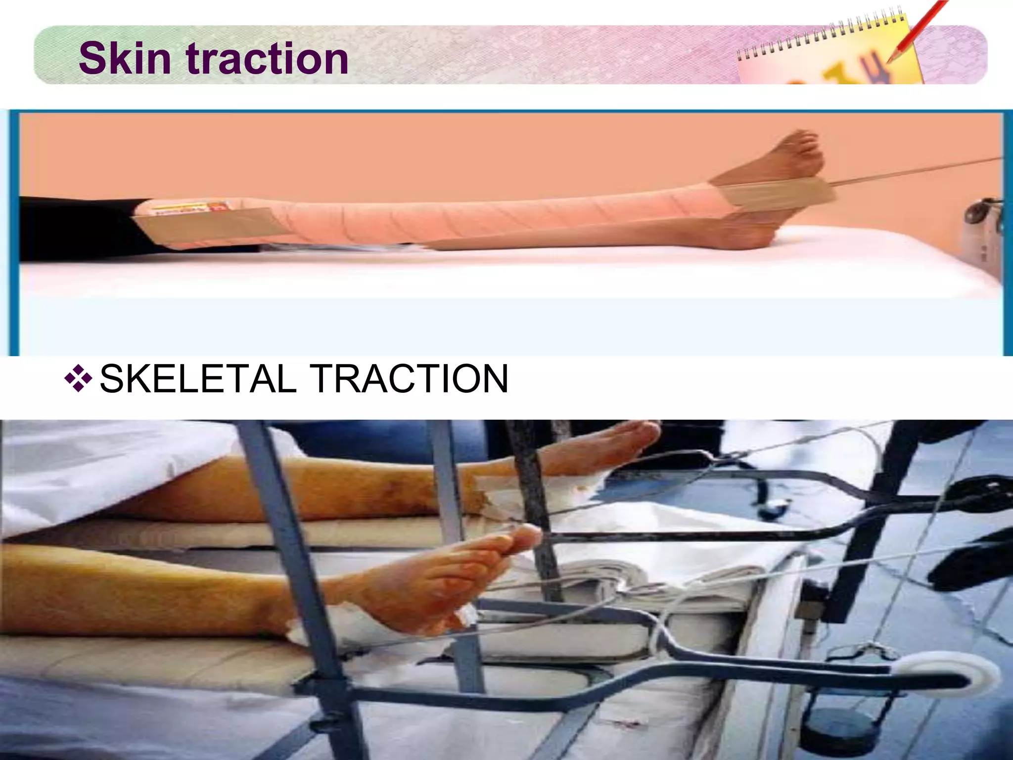 Fracture in children | PPT