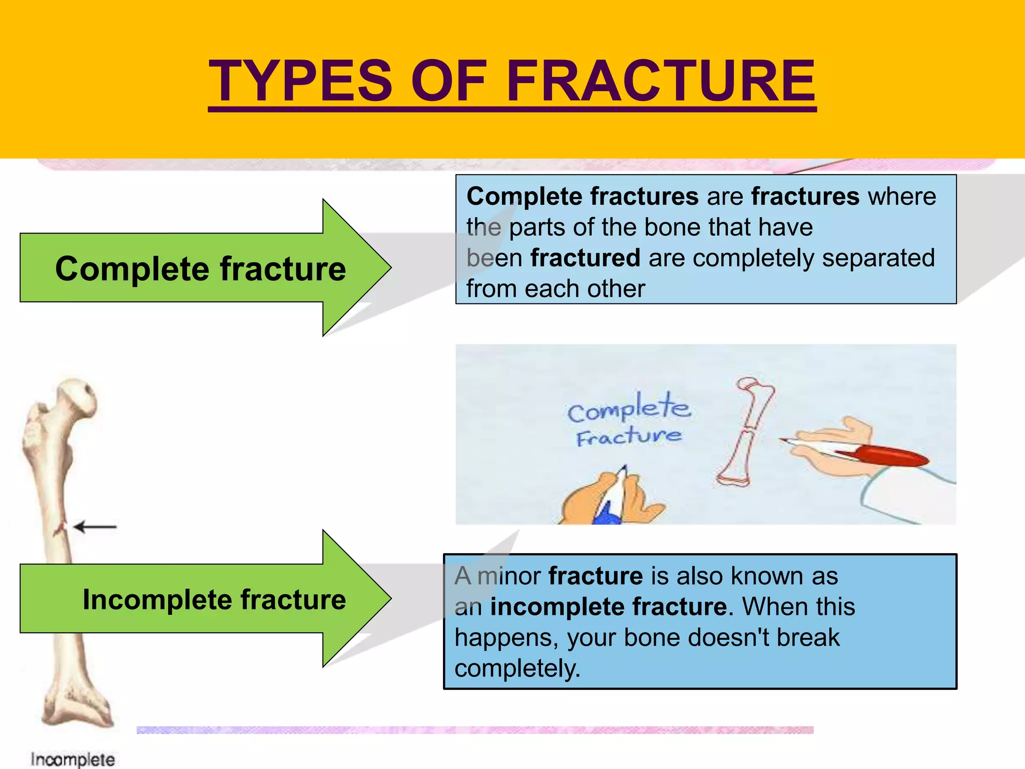 Fracture in children | PPT