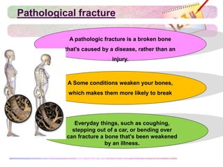Fracture in children | PPT