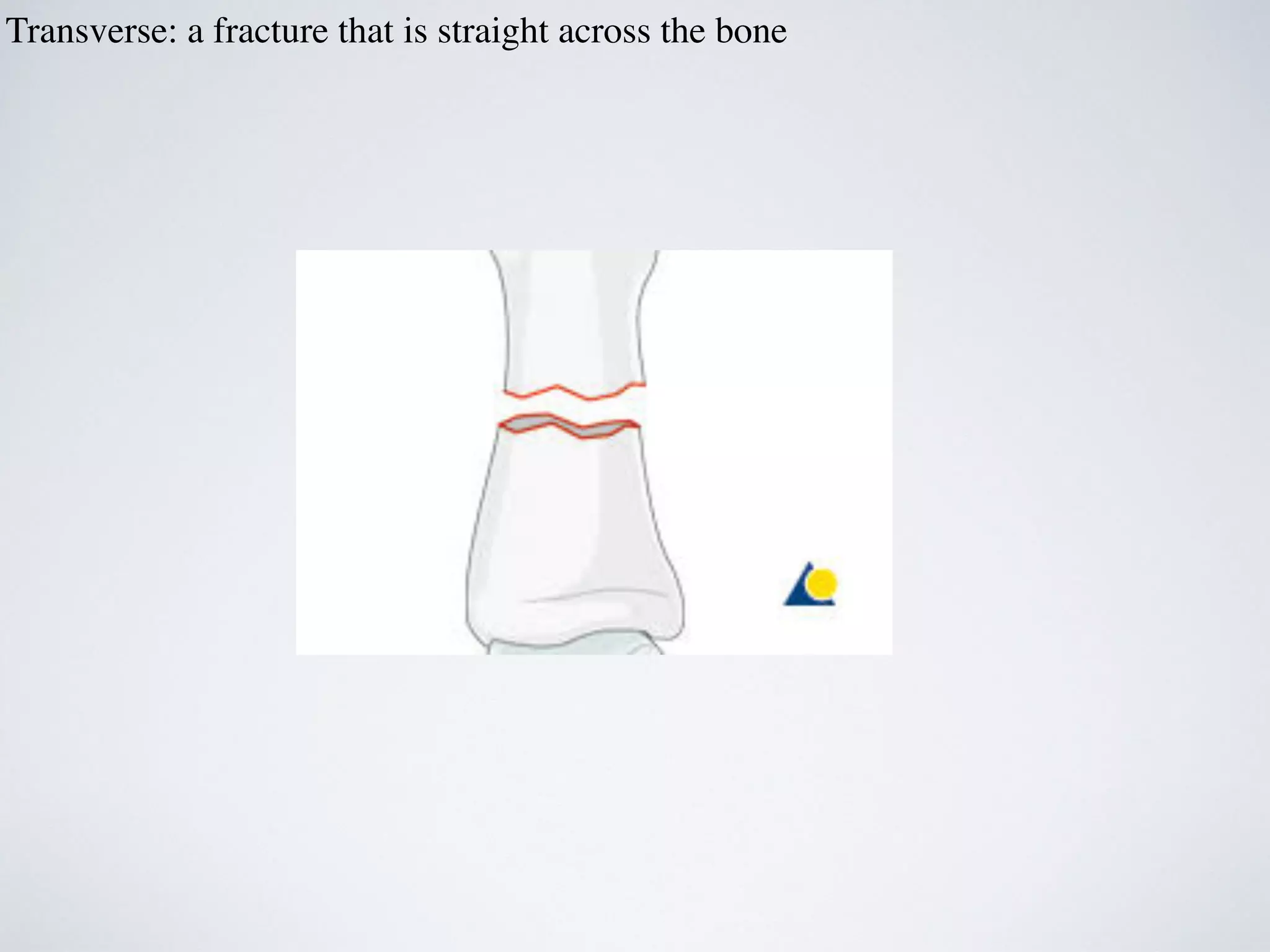 Fracture | PDF