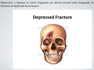 Fracture | PDF