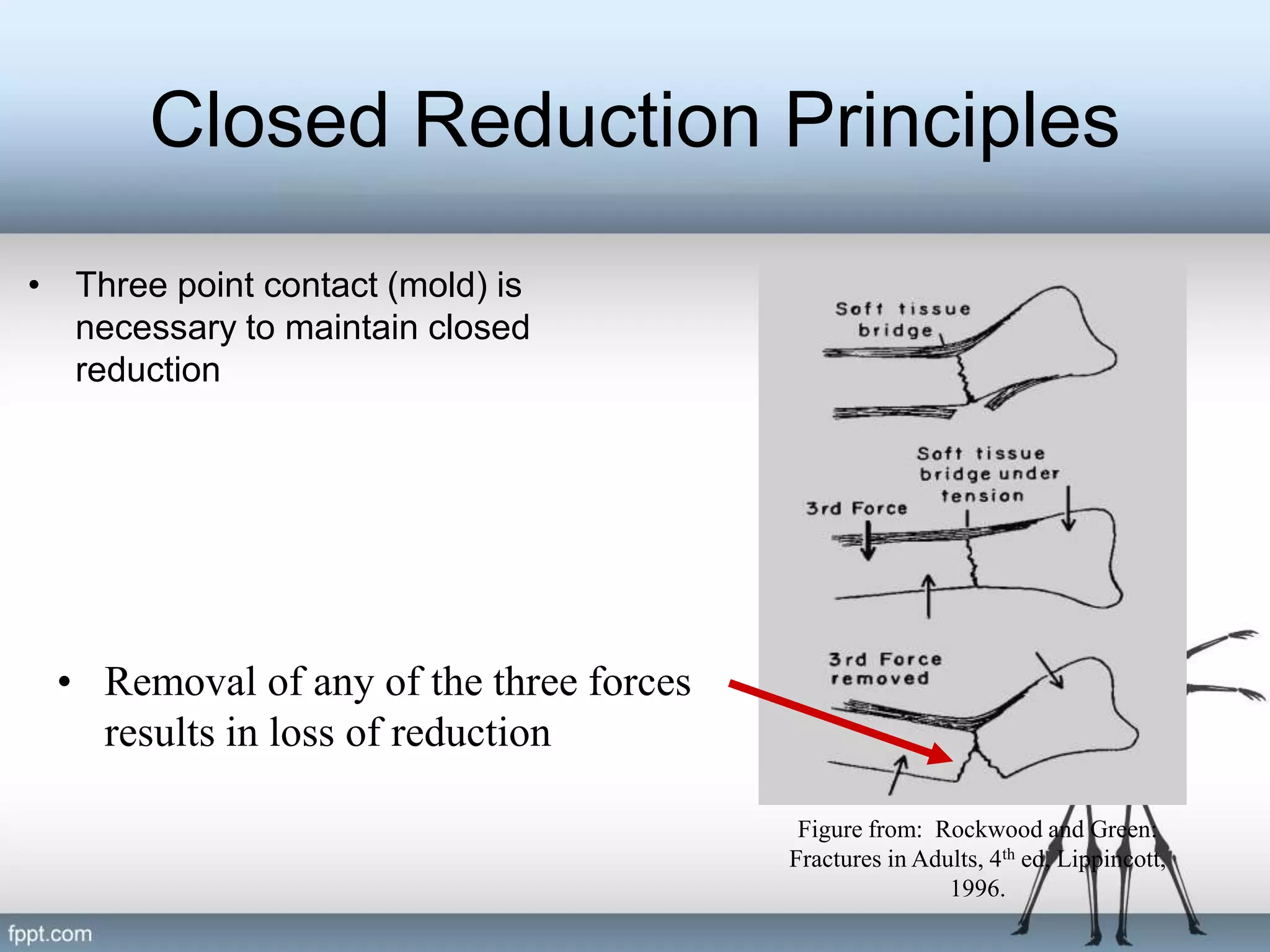 CONSERVATIVE MANAGEMENT OF FRACTURE | PPT