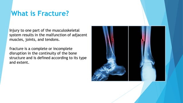 Fracture.pptx