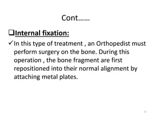 FRACTURE | PPTX