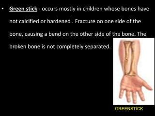 fracture.pptx