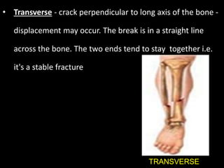 fracture.pptx