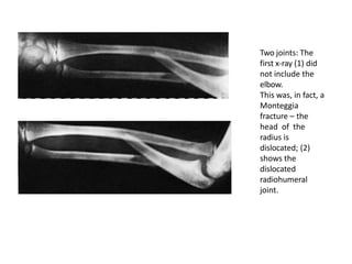 Fracture- Clinic presentation, types and complications | PPTX