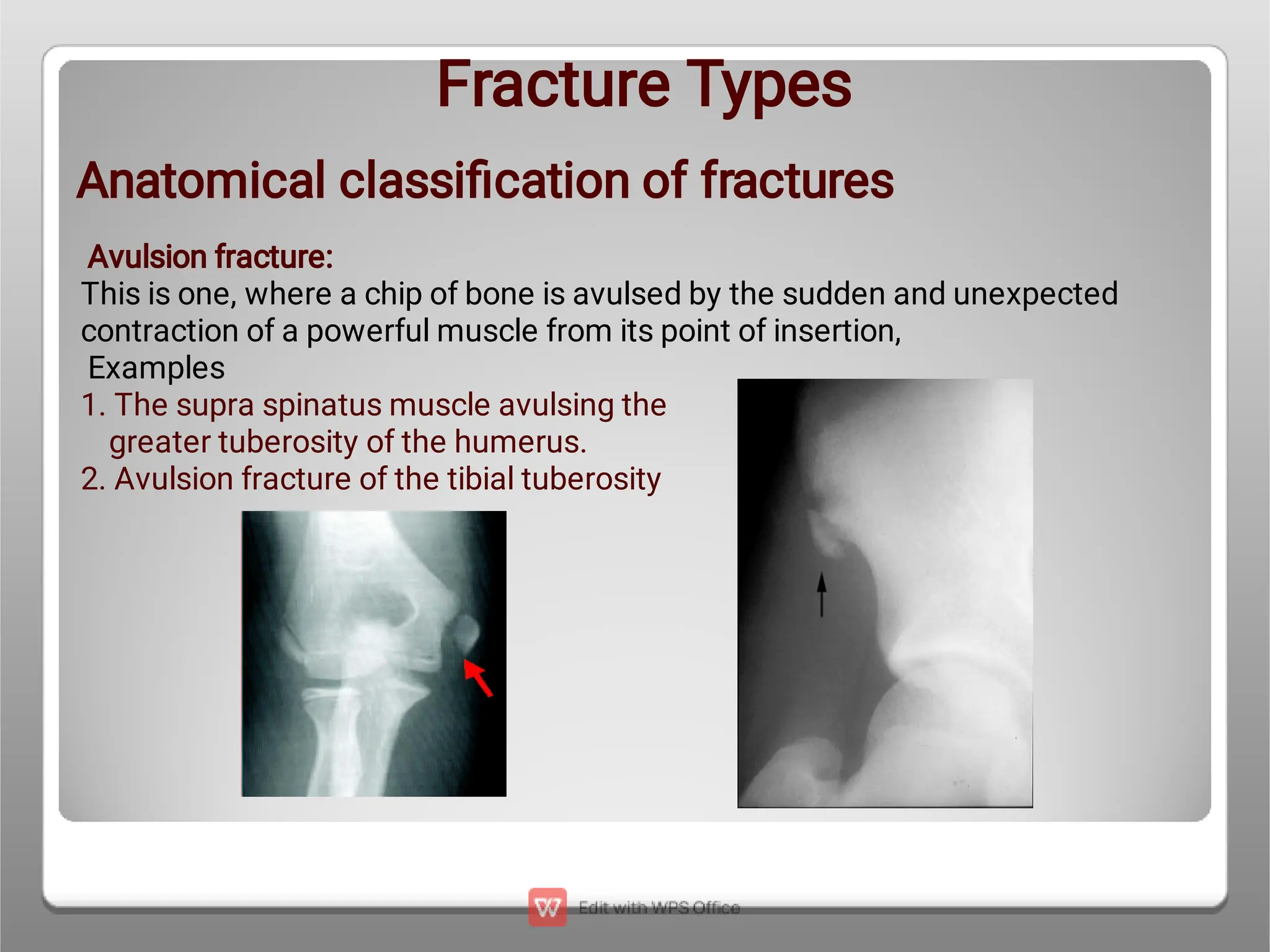 Definition of fracture it's types , symptoms and treatment | PDF