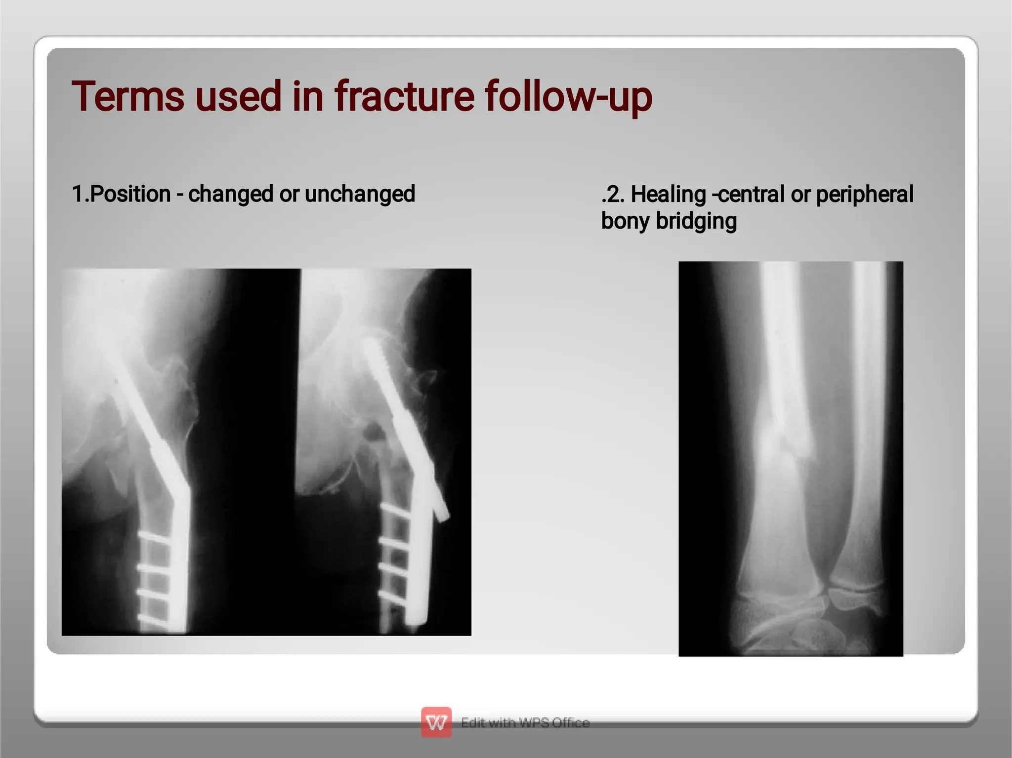 Definition of fracture it's types , symptoms and treatment | PDF