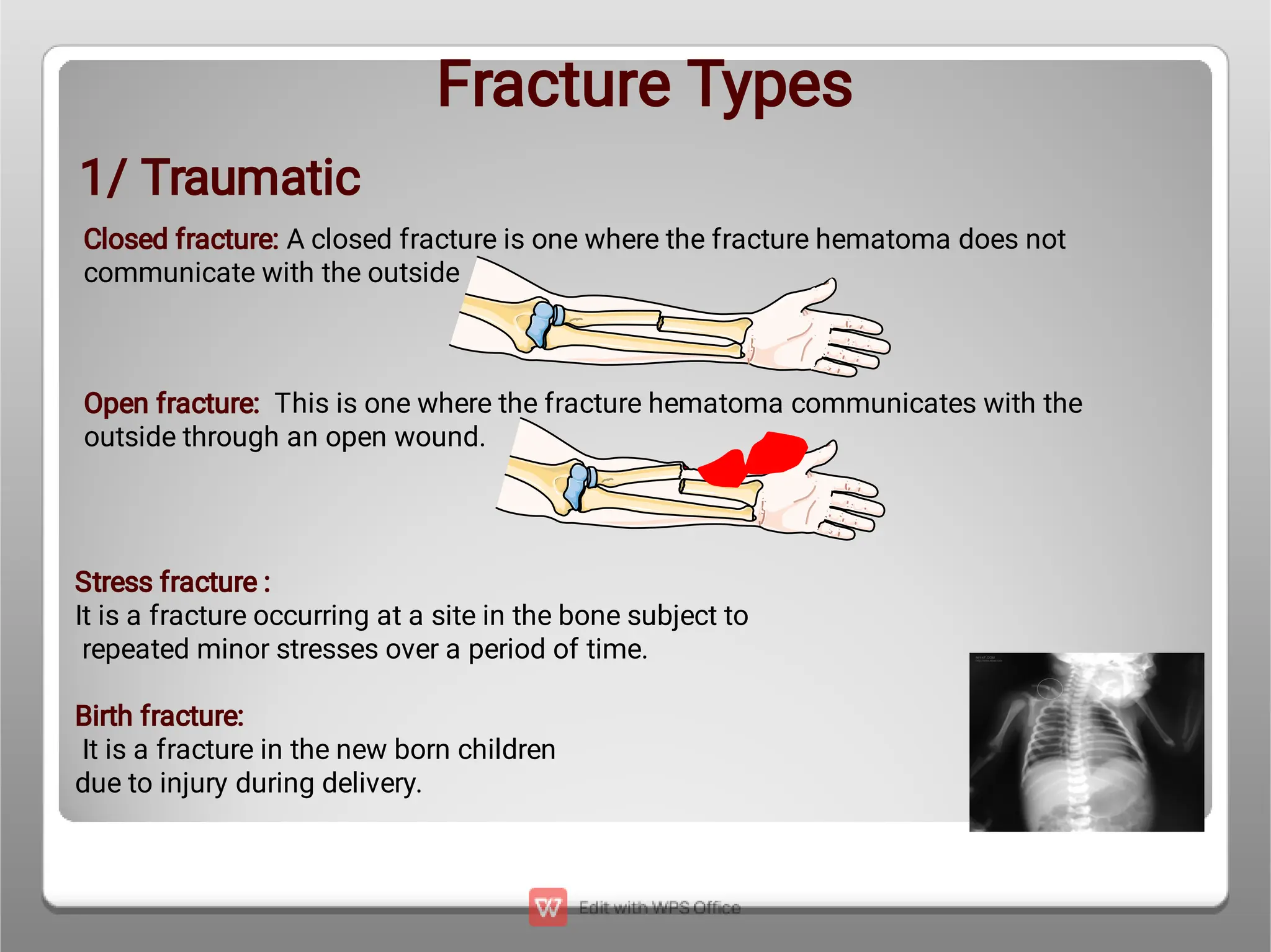Definition of fracture it's types , symptoms and treatment | PDF