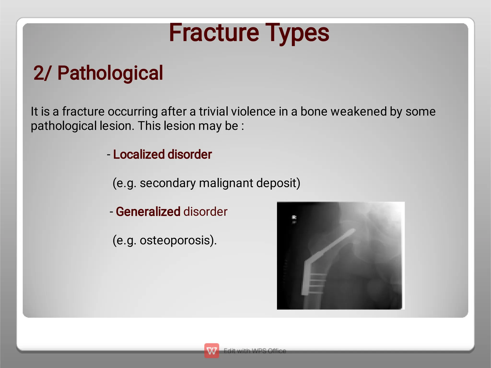 Definition of fracture it's types , symptoms and treatment | PDF