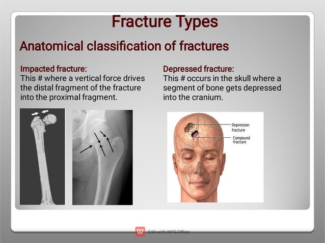 Definition of fracture it's types , symptoms and treatment | PDF