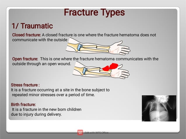 Definition of fracture it's types , symptoms and treatment | PDF