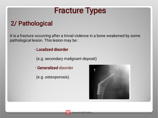 Definition of fracture it's types , symptoms and treatment | PDF