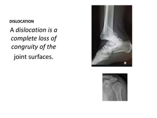 FRACTURES FOR HOMOEOPATHIC STUDIENTS SURGERY | PPTX