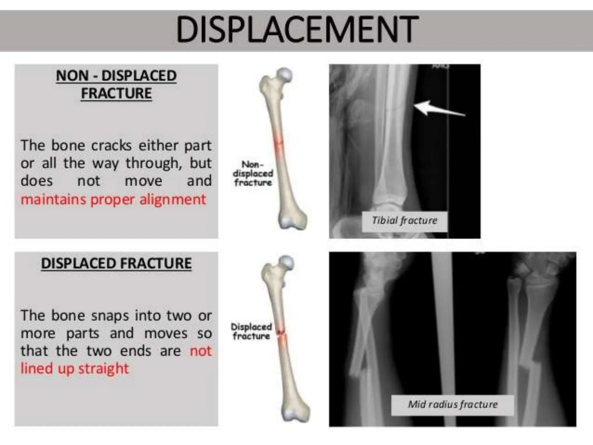 FRACTURE PPT (ORTHOPAEDIC) ALL BASIC INFORMATION | PPTX