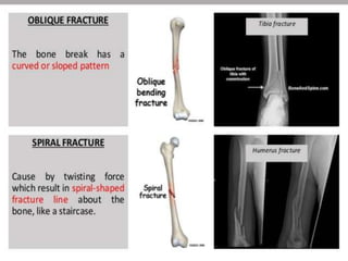FRACTURE PPT (ORTHOPAEDIC) ALL BASIC INFORMATION | PPTX