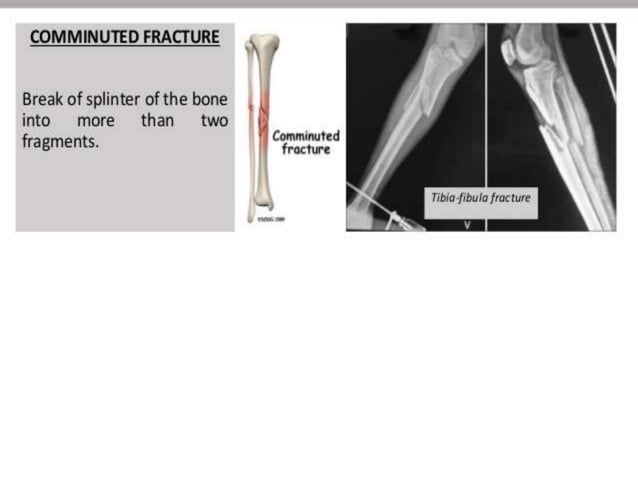 FRACTURE PPT (ORTHOPAEDIC) ALL BASIC INFORMATION | PPTX