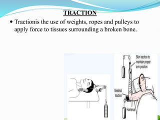 FRACTURE PPT (ORTHOPAEDIC) ALL BASIC INFORMATION | PPTX
