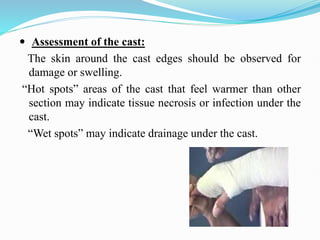 FRACTURE PPT (ORTHOPAEDIC) ALL BASIC INFORMATION | PPTX