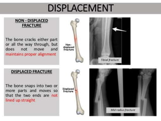 FRACTURE PPT (ORTHOPAEDIC) ALL BASIC INFORMATION | PPTX