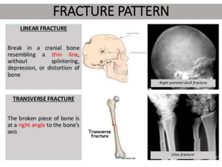 FRACTURE PPT (ORTHOPAEDIC) ALL BASIC INFORMATION | PPTX